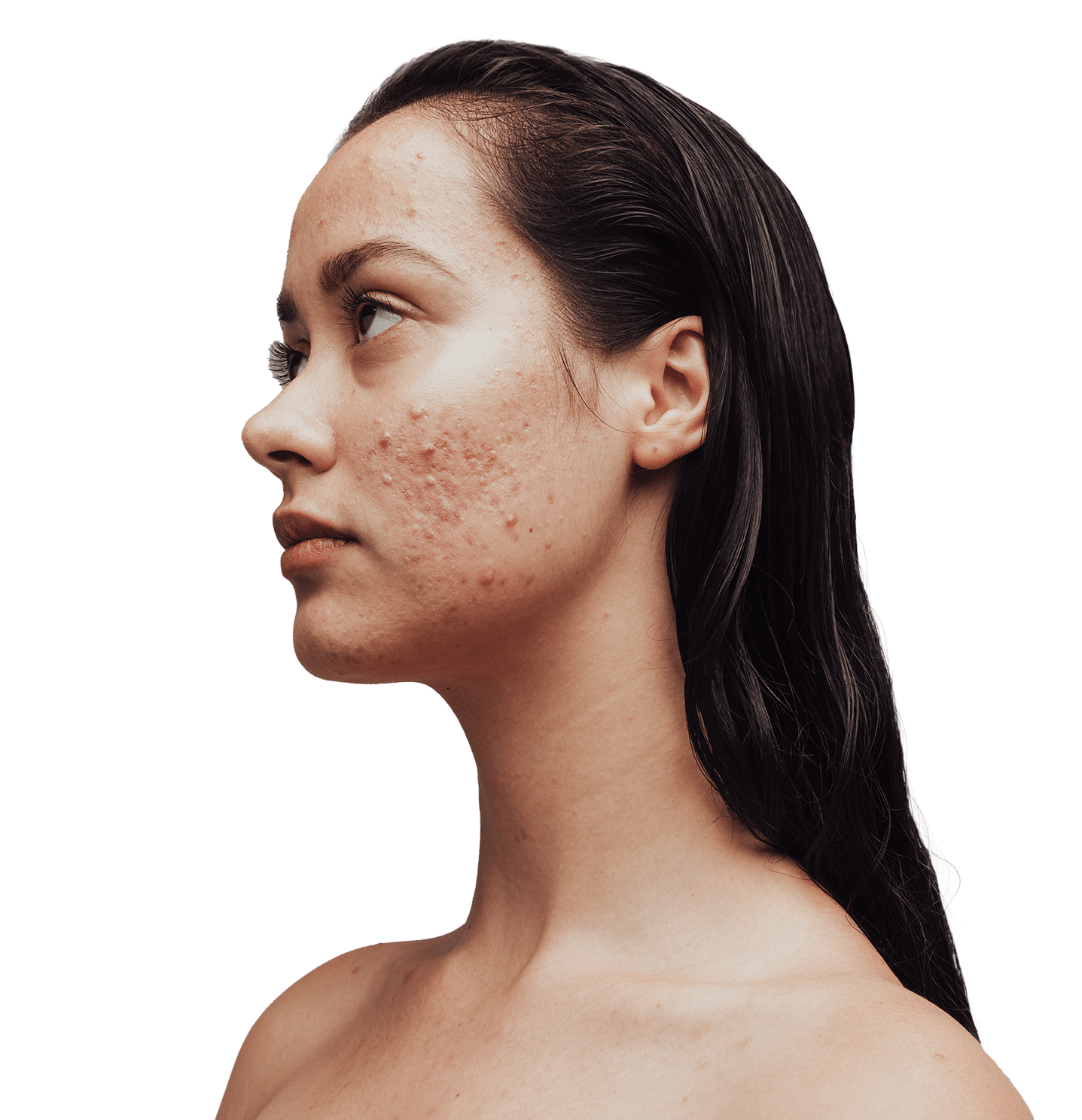 Acné behandeling in Amsterdam | Mommy Skincare Clinic